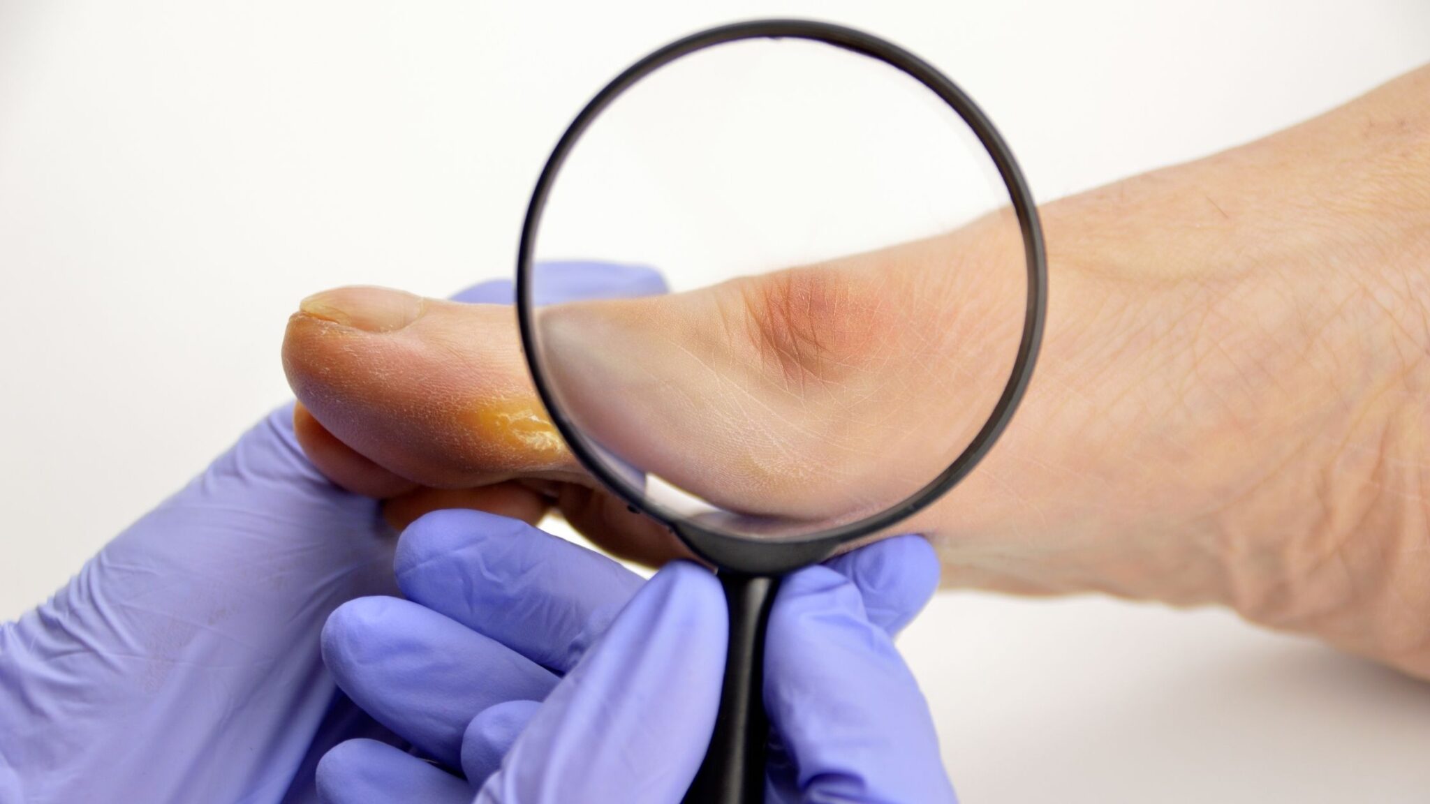 Big Toe Bunion - Symptoms, Causes, and Treatments of Foot Bunion