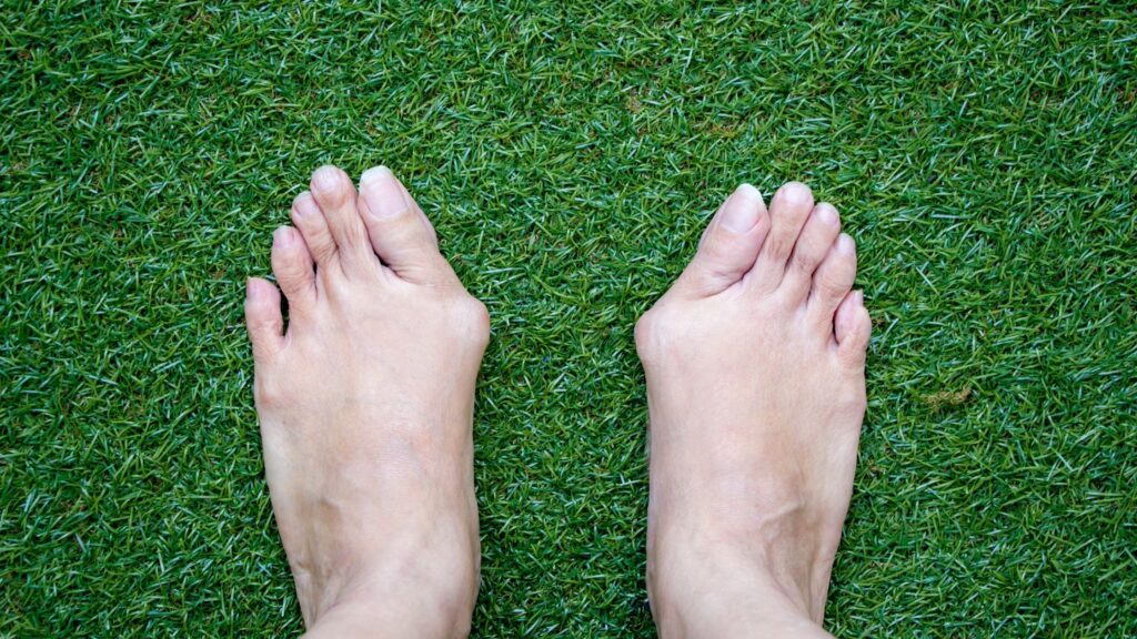 Big Toe Bunion - Symptoms, Causes, and Treatments of Foot Bunion